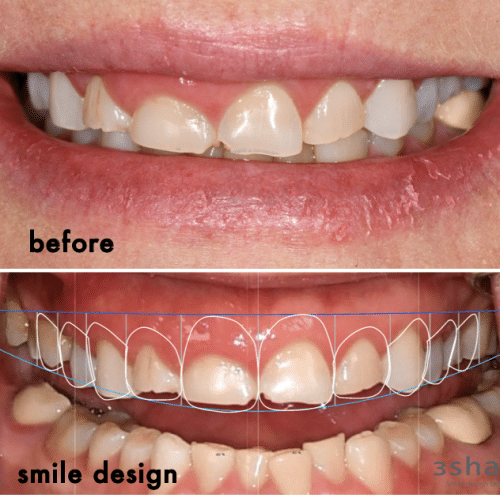 Digital Smile Design: Virtual to Reality | Dentistry of Mendham
